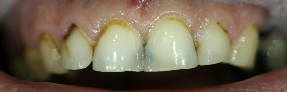 Dental Filling Front Teeth