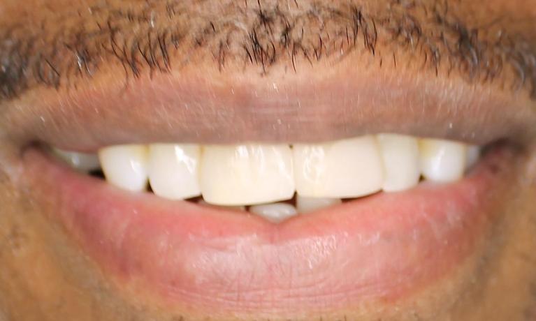 Gapped Tooth Closure | Before & After | Anderson SC Dentist