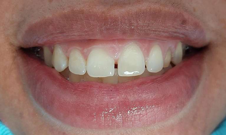 Anderson SC Dentist | Before & After Dental Photos