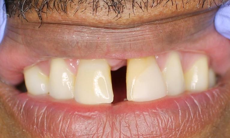 Gapped Tooth Closure | Before & After | Anderson SC Dentist