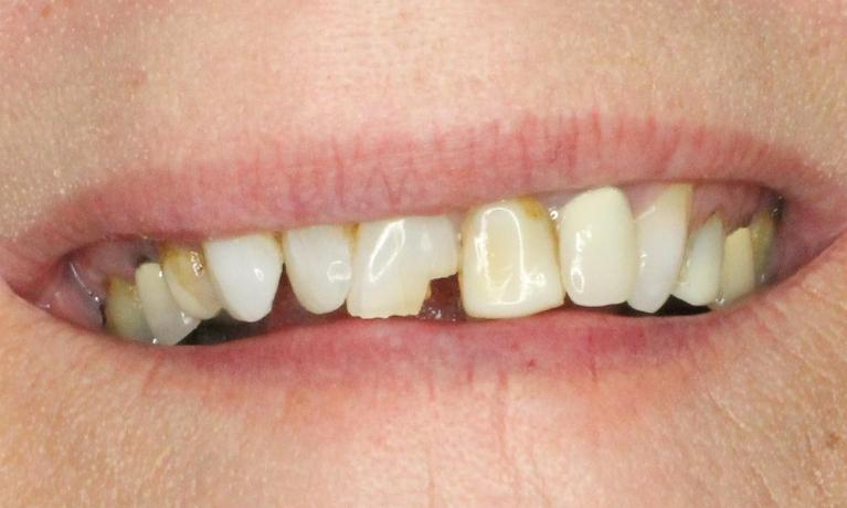 Anderson SC Dentist | Before & After Dental Photos